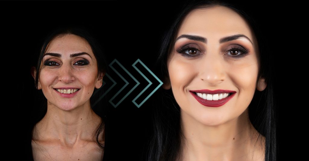 Zähne abschleifen für Veneers I Dr. Pfitzer